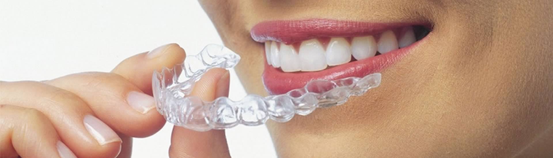 Invisalign Clear Braces | Maxident Clinic